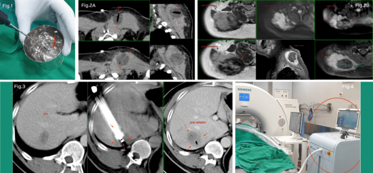 Cryoablation in Mumbai, India - Minimally Invasive Treatment for ...