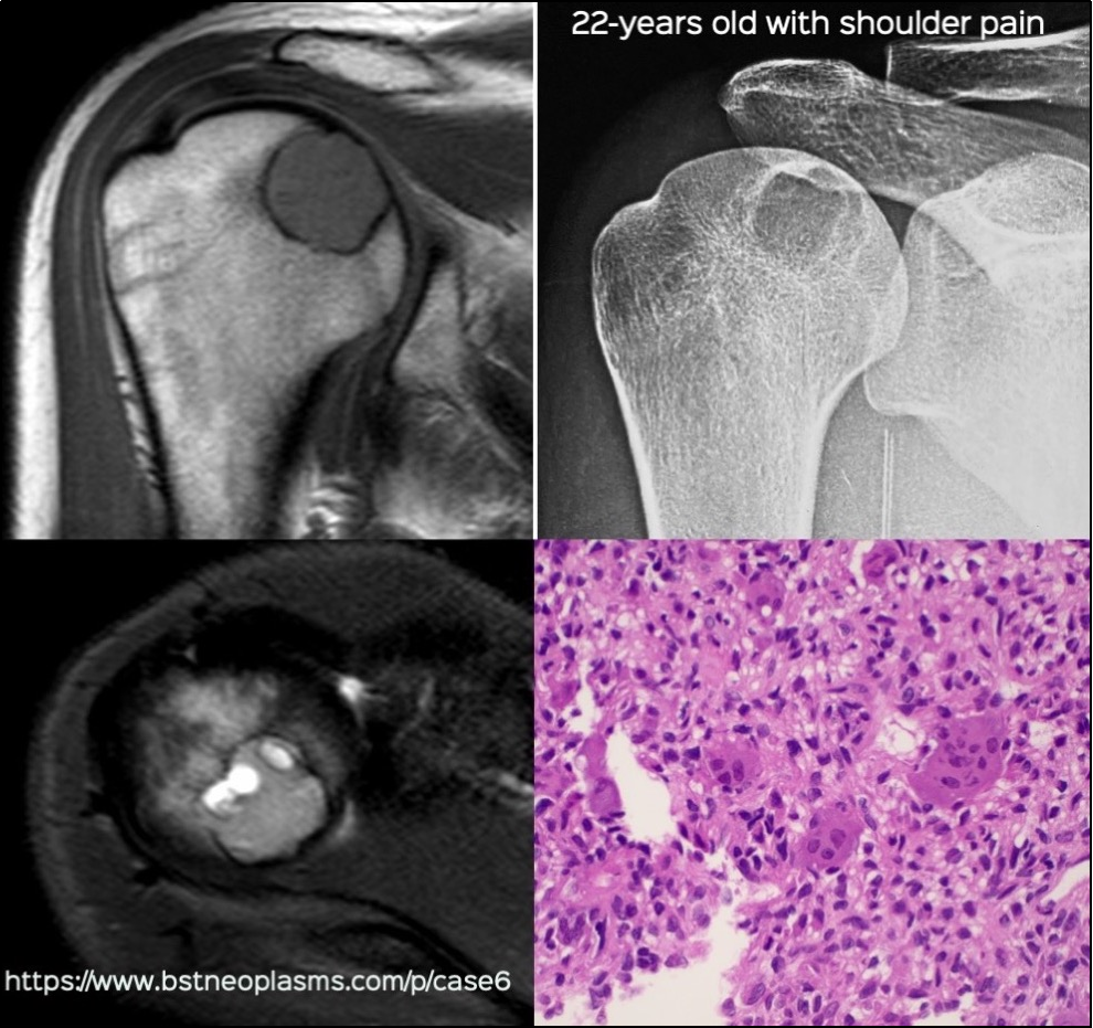 Cryoablation of Chondroblastoma - Non-Surgical Treatment in Mumbai ...