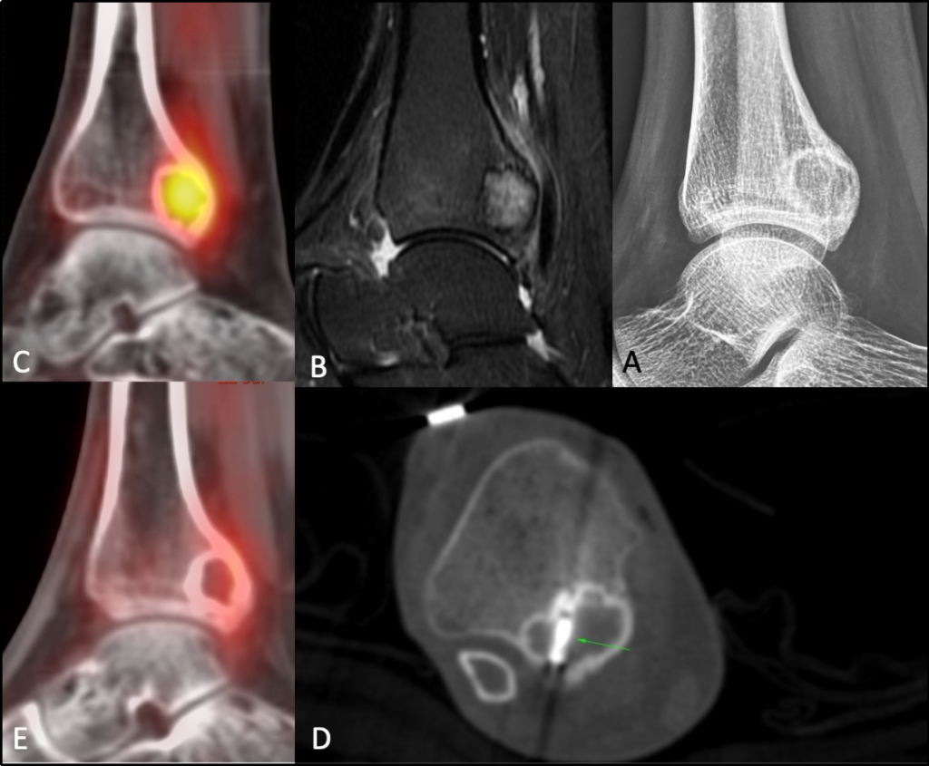 Benign Aggressive Bone Tumors - Understanding the Concept | Picture This