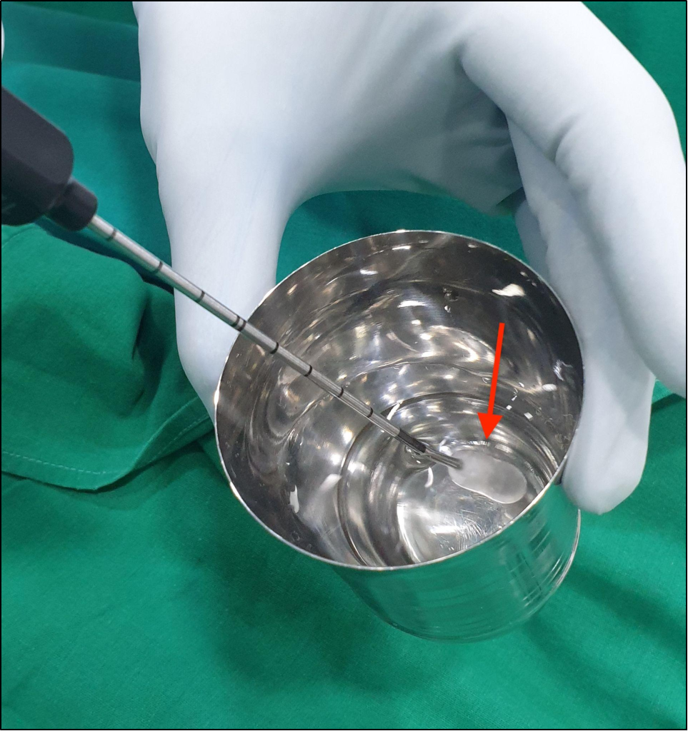 Cryoablation of Chondroblastoma - Non-Surgical Treatment in Mumbai ...