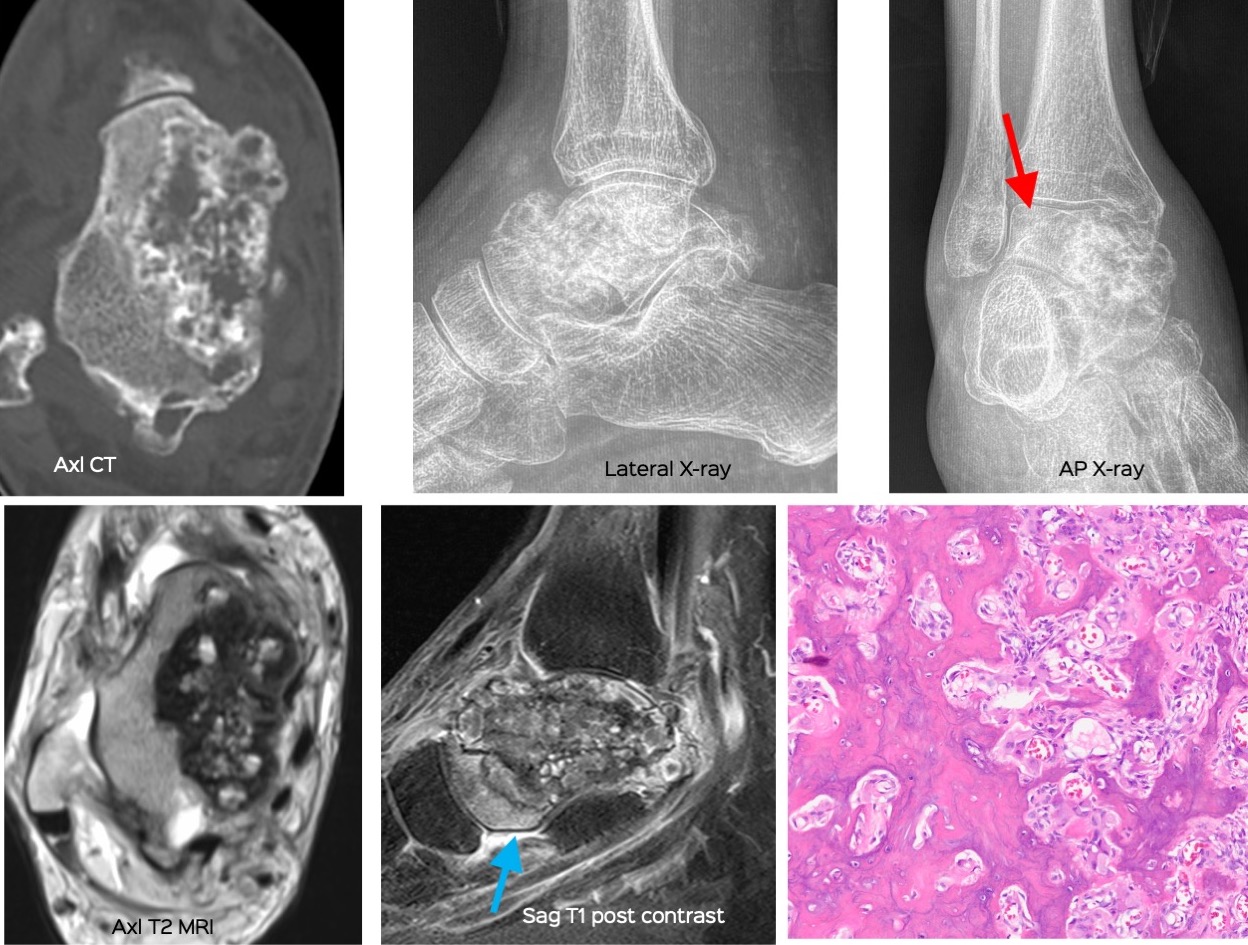 Benign Aggressive Bone Tumors - Understanding the Concept | Picture This