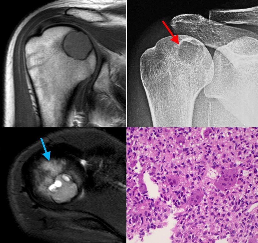 Benign Aggressive Bone Tumors - Understanding the Concept | Picture This
