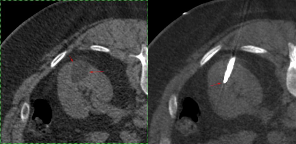 Cryoablation of Renal Tumors - Picture This